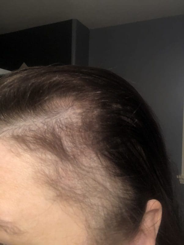 My Experience With Ophiasis Alopecia So Far