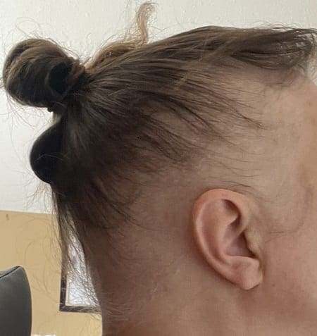 My Experience With Ophiasis Alopecia So Far